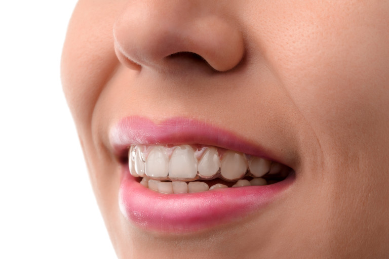 Invisalign Manchester vs Veneers – The Best Way To Straighten teeth | Blog